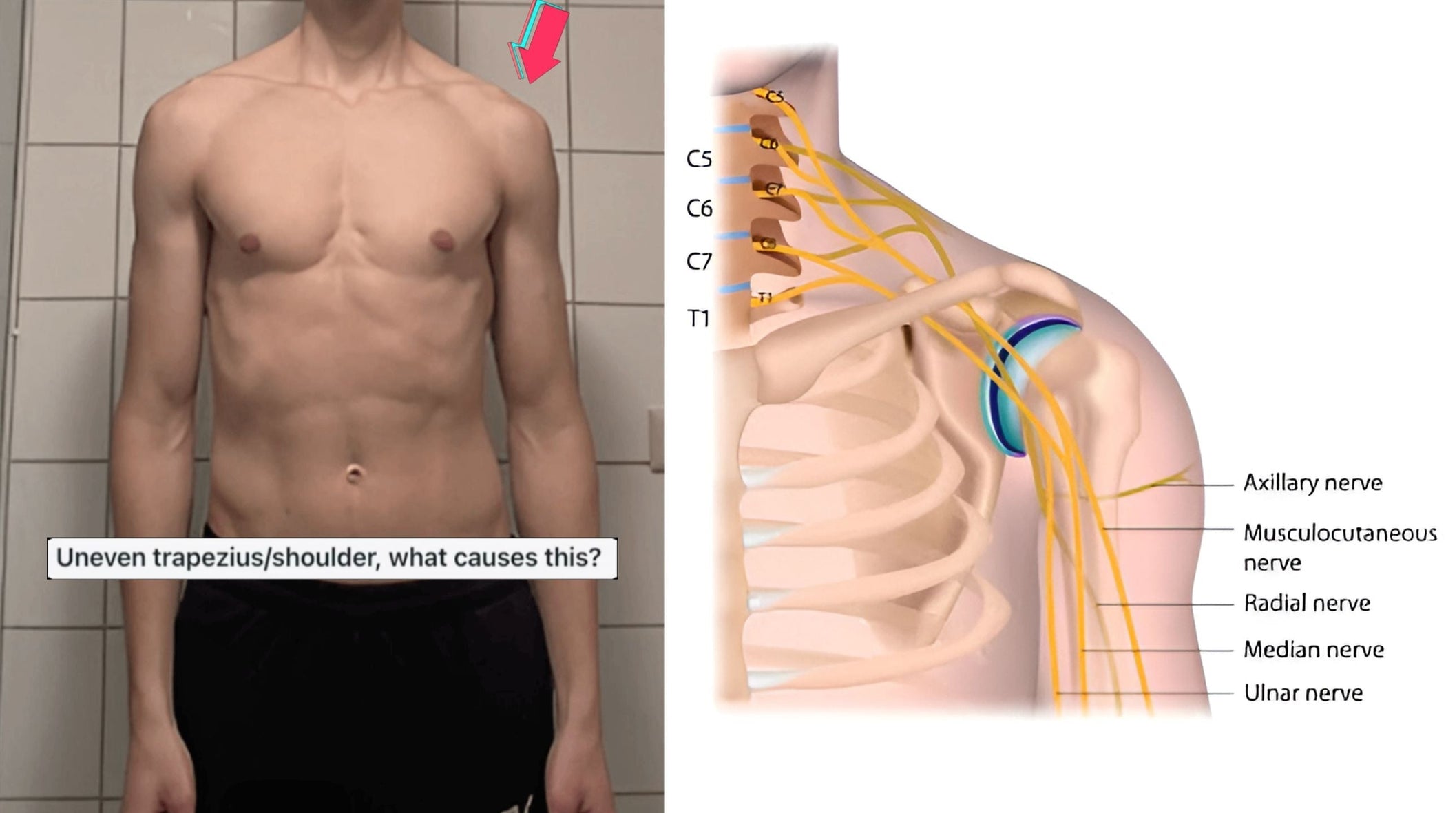 Shoulder Imbalance FIXED in 30 Seconds – Posturepro