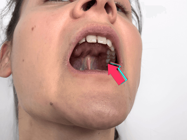 Mastering Proper Tongue Posture: A Guide for Improved Breathing and Po ...