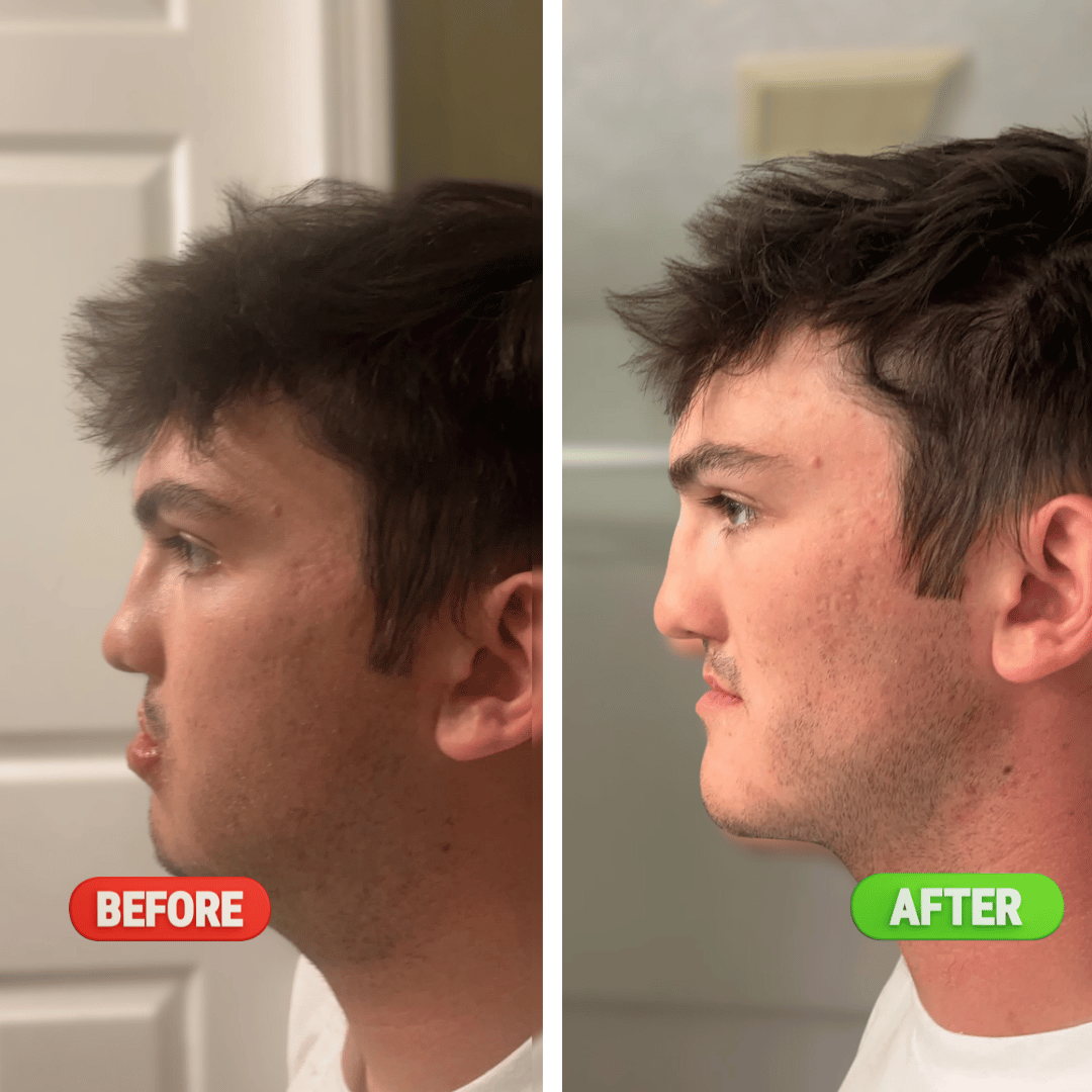 Best Mewing Solution by Posturepro – Posturepro