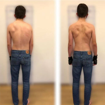 How To Fix Uneven Shoulders – Posturepro